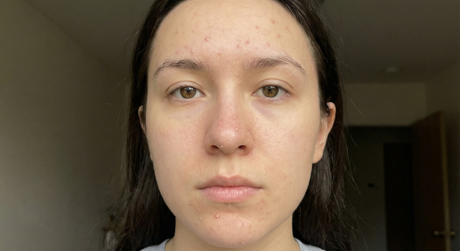 How To Treat Comedones Effectively At Home